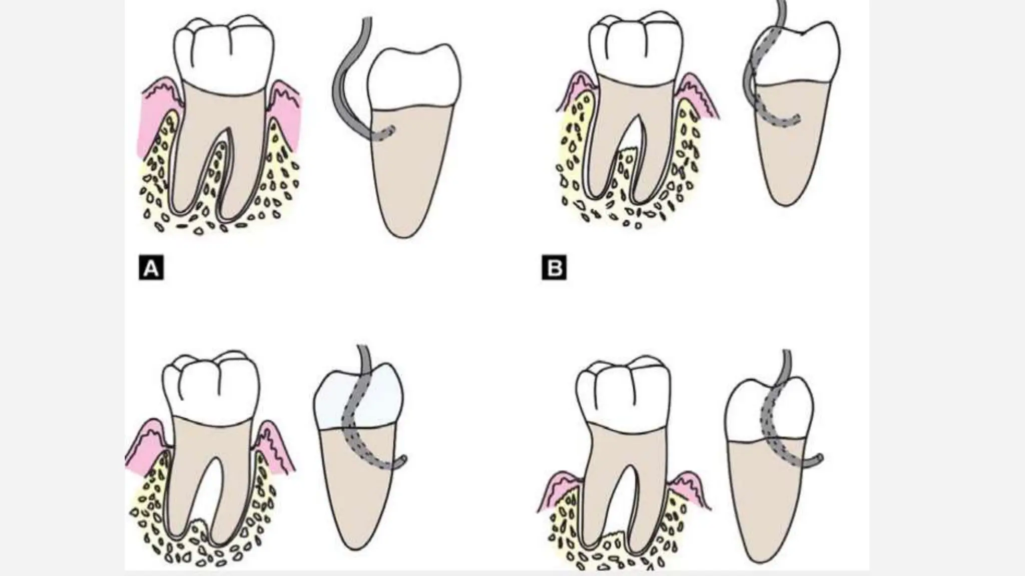 Furcation involvement-periodontology-2.pptx