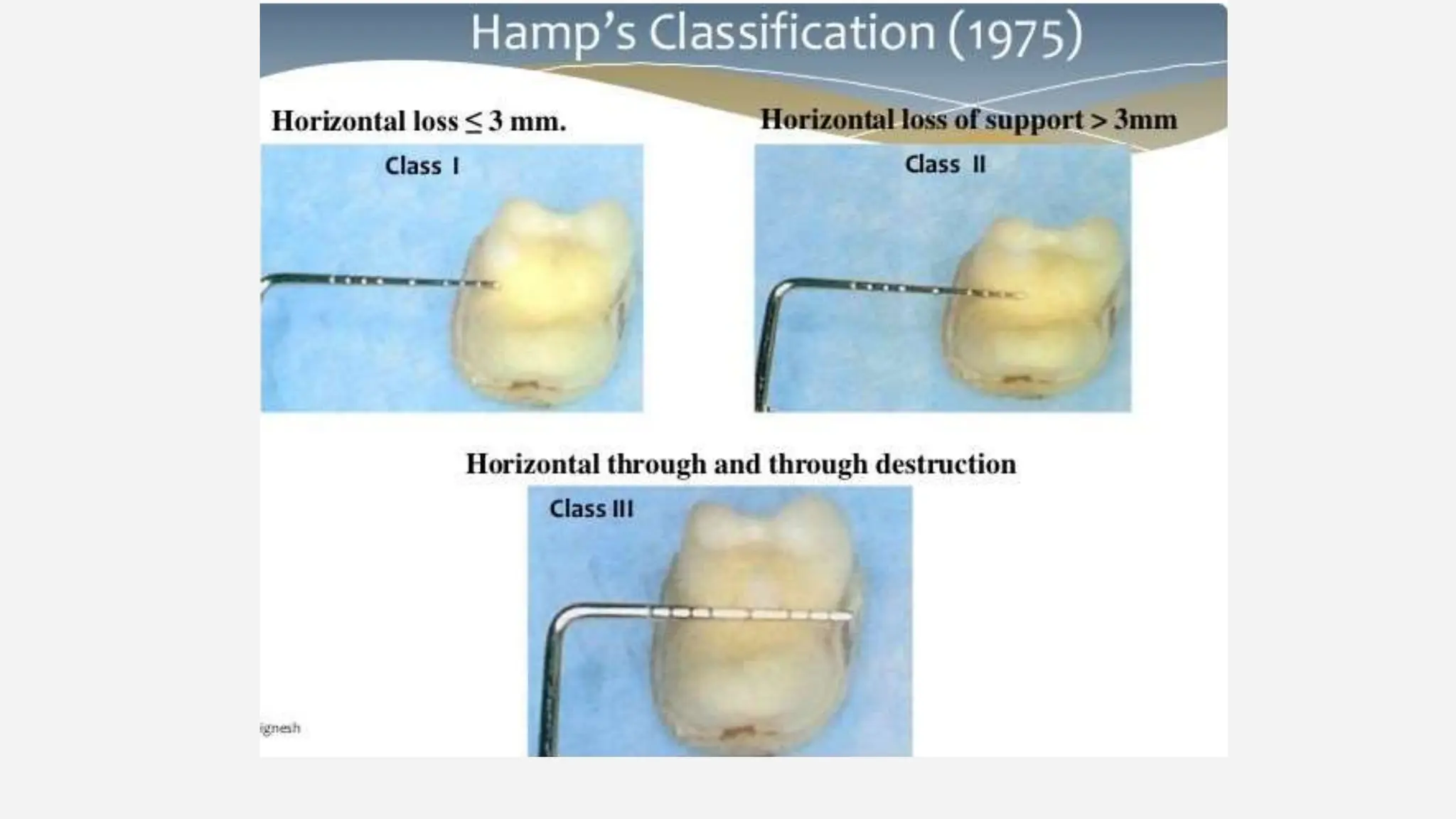 Furcation involvement-periodontology-2.pptx