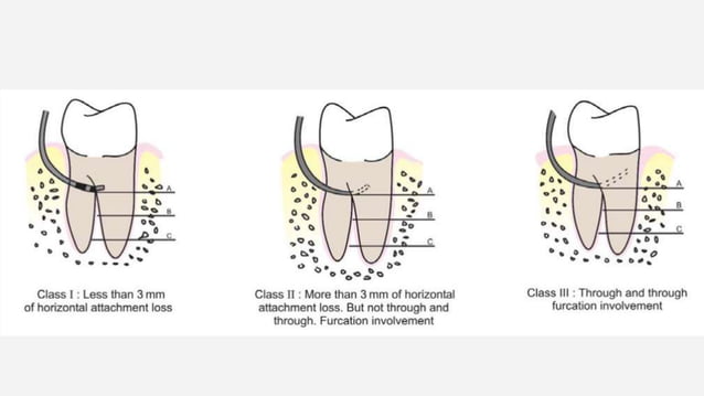 Furcation involvement-periodontology-2.pptx