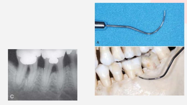 Furcation involvement-periodontology-2.pptx