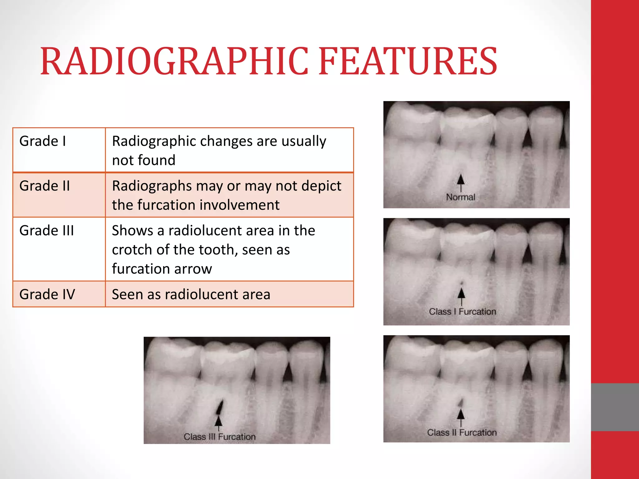 Furcation involvement | PPTX