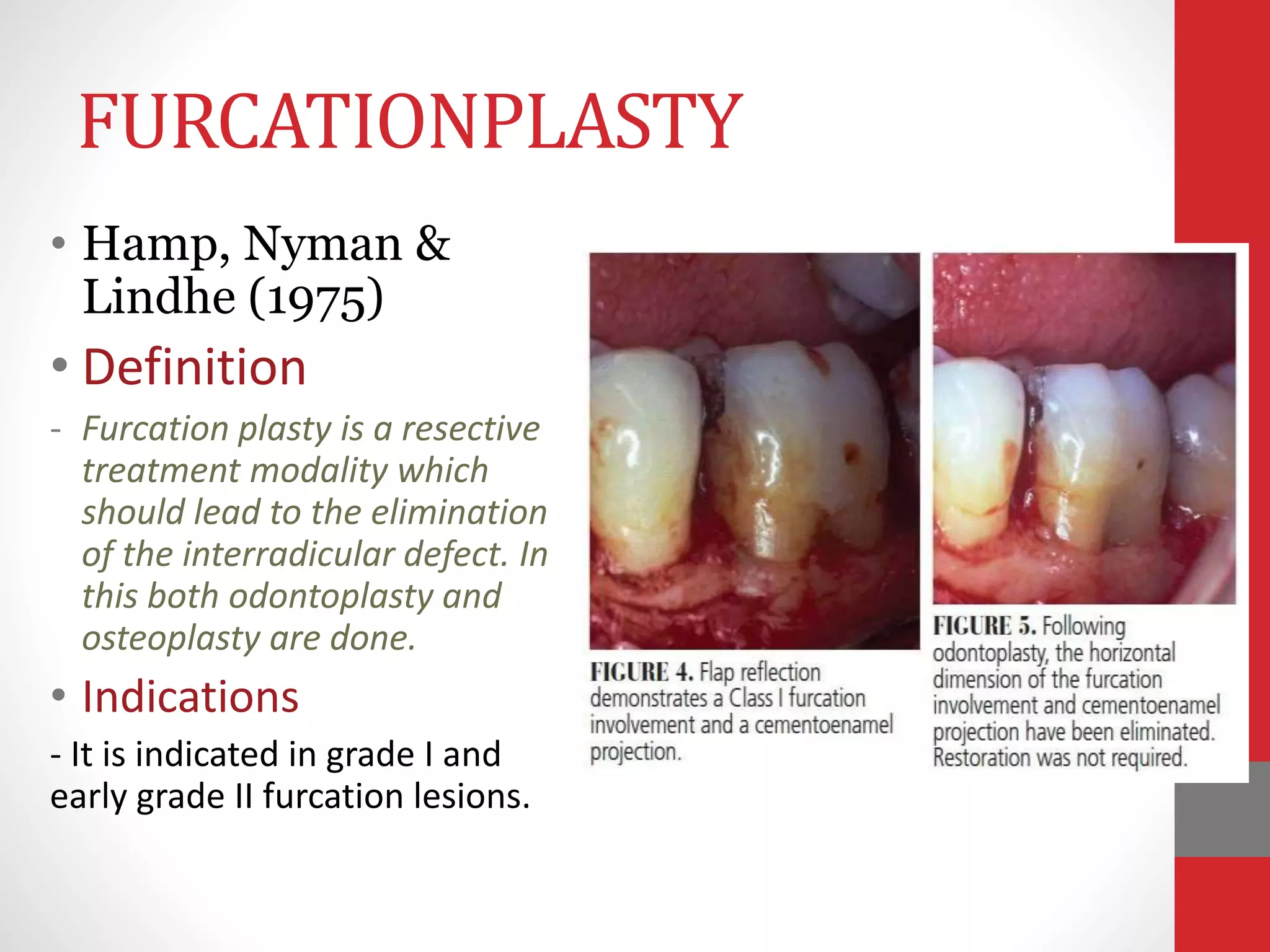 Furcation involvement | PPTX