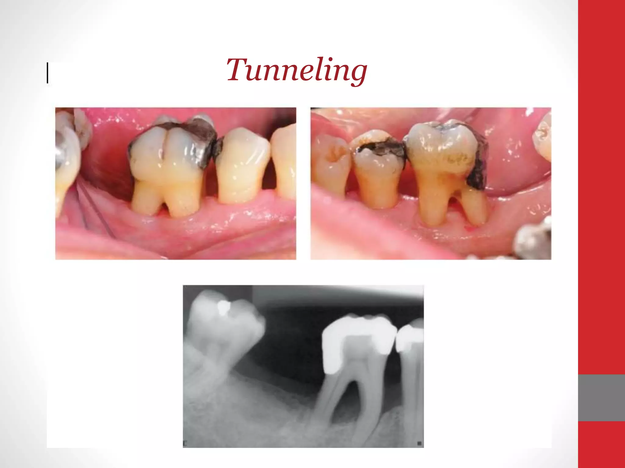 Furcation involvement | PPTX