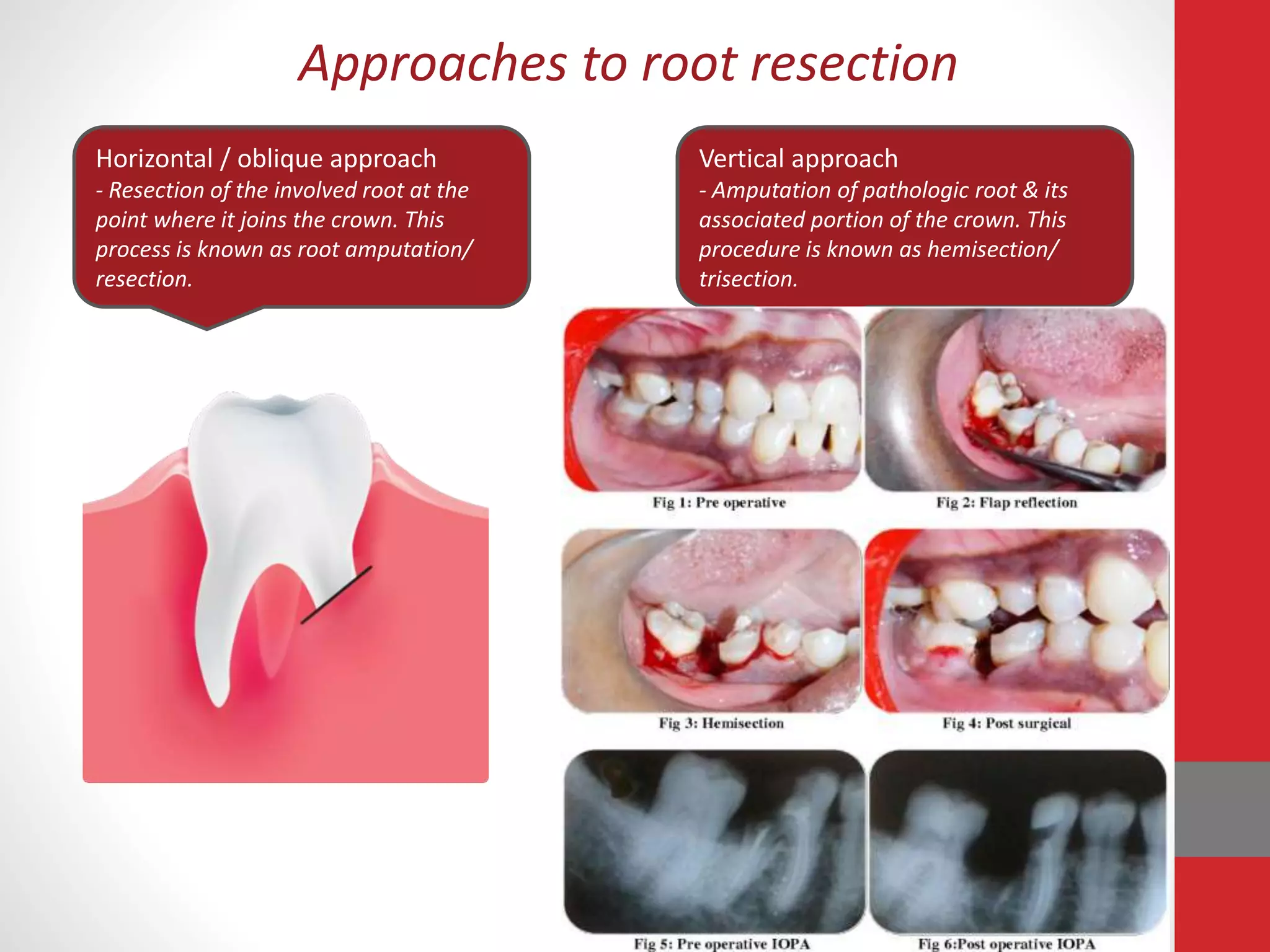 Furcation involvement | PPTX