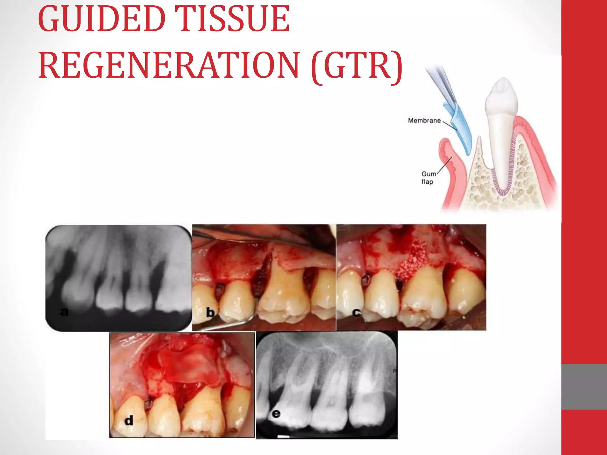 Furcation involvement | PPTX