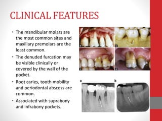 Furcation involvement | PPTX
