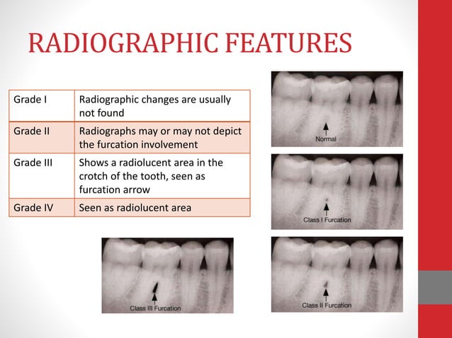 Furcation involvement | PPTX | Dental Health | Diseases and Conditions