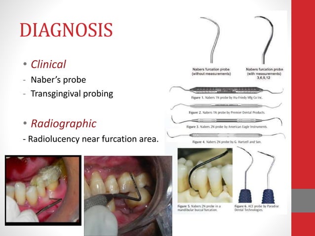 Furcation involvement | PPTX | Dental Health | Diseases and Conditions