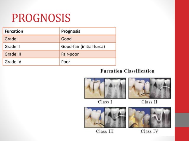 Furcation involvement | PPTX | Dental Health | Diseases and Conditions