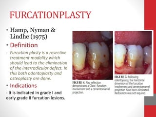 Furcation involvement | PPTX