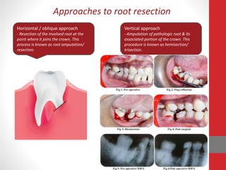 Furcation involvement | PPTX