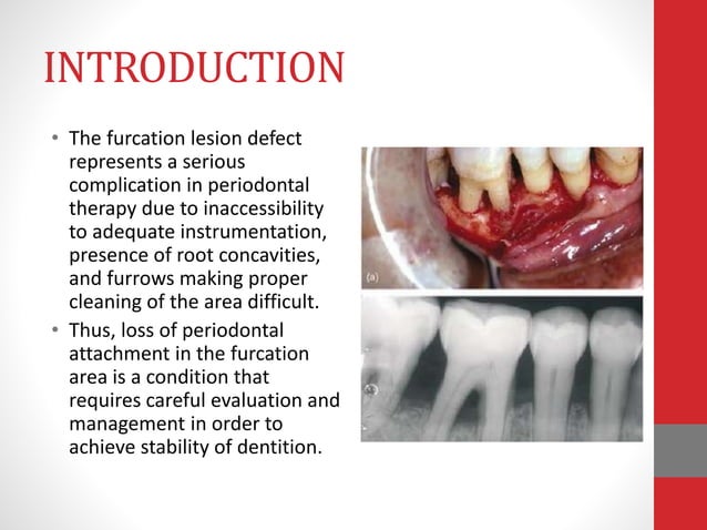 Furcation involvement | PPTX | Dental Health | Diseases and Conditions