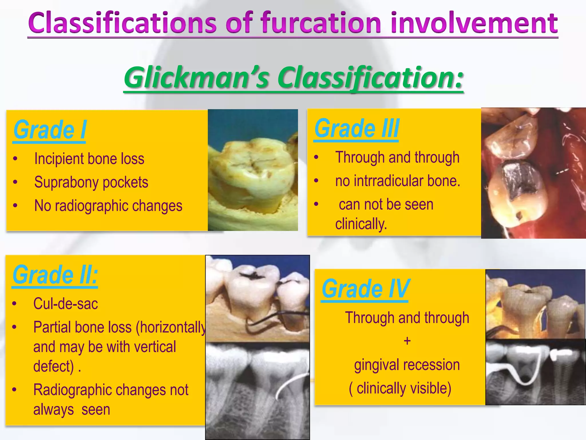 Furcation involvements and its treatments | PPTX
