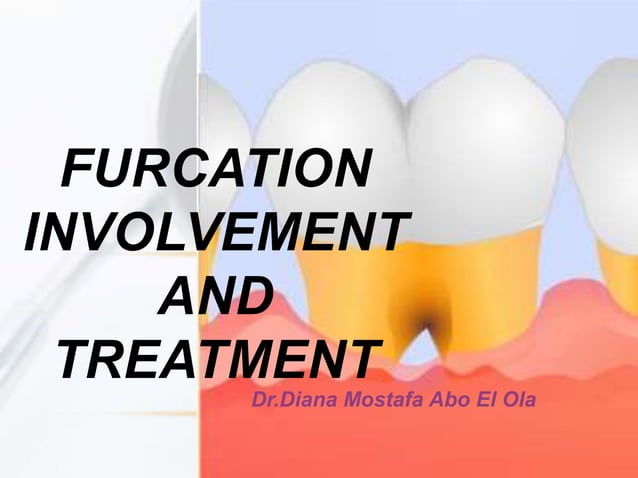 Furcation involvements and its treatments | PPTX