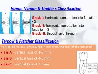 Furcation involvements and its treatments | PPTX
