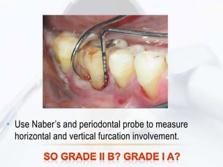 Furcation involvements and its treatments | PPTX