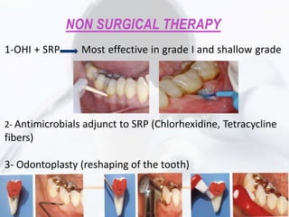 Furcation involvements and its treatments | PPTX