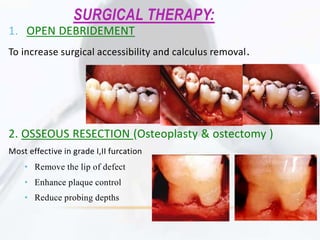 Furcation involvements and its treatments | PPTX