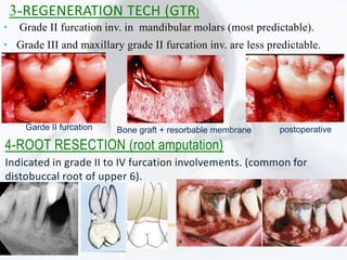 Furcation involvements and its treatments | PPTX