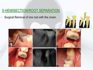 Furcation involvements and its treatments | PPTX