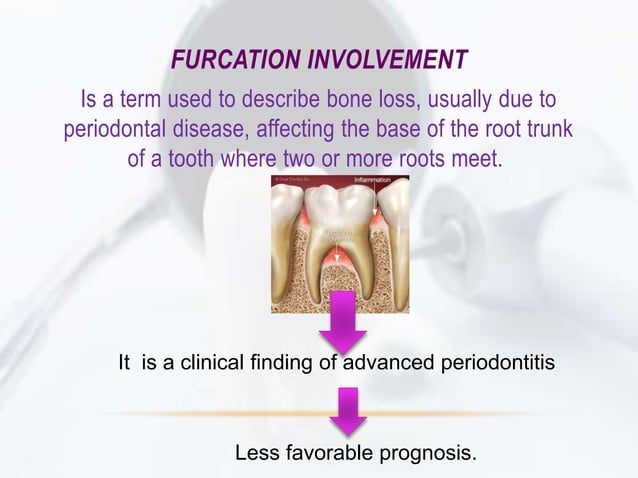 Furcation involvements and its treatments | PPTX