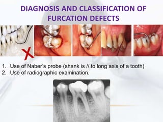 Furcation involvements and its treatments | PPTX