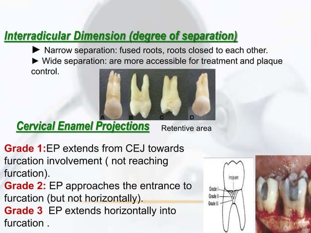 Furcation involvements and its treatments | PPTX