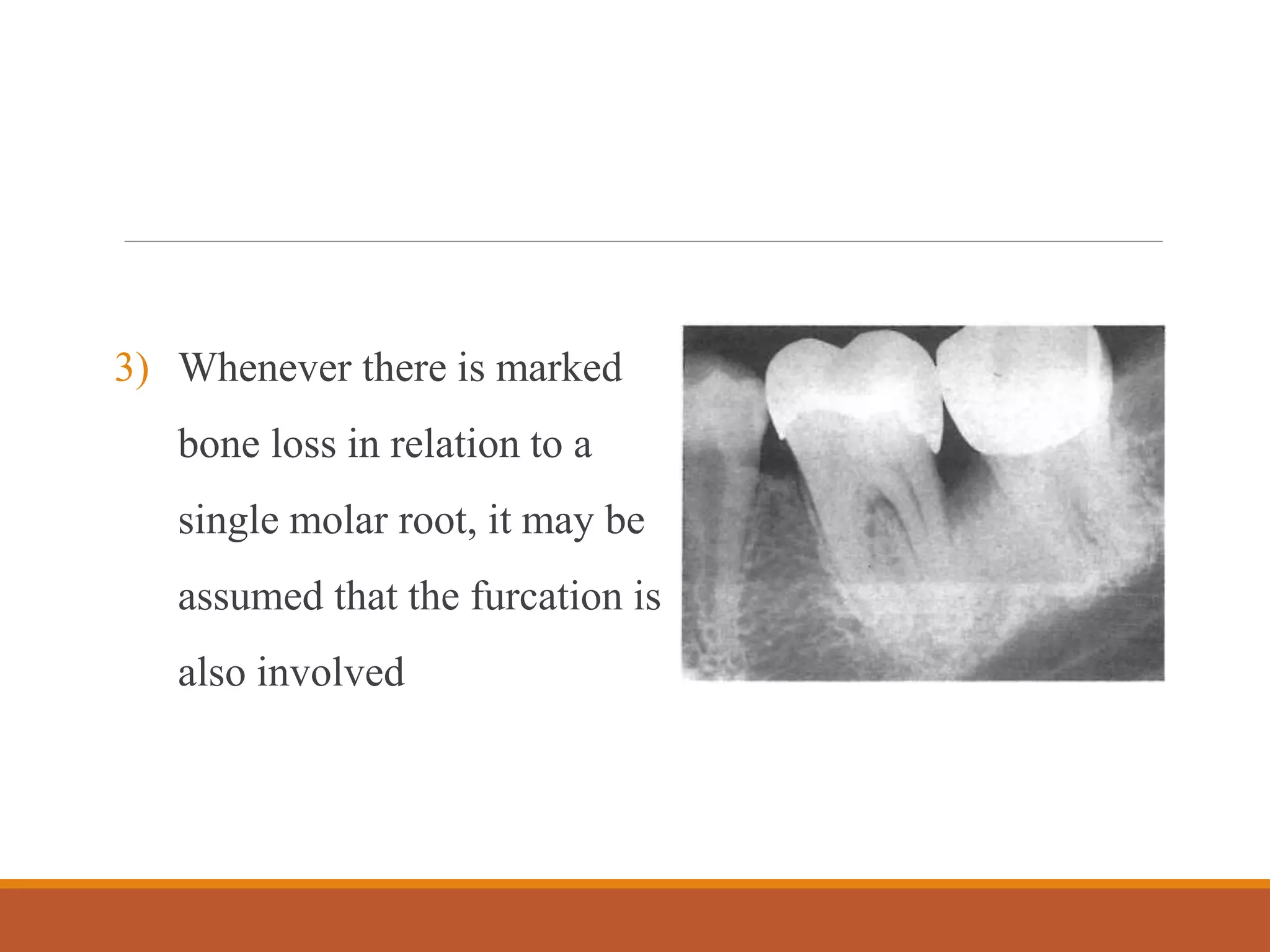 Furcation involvement | PPT
