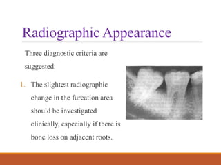 Furcation involvement | PPT