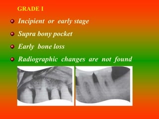 FURCATION MANAGEMENT.ppt