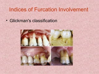 Furcation ppt | PPT