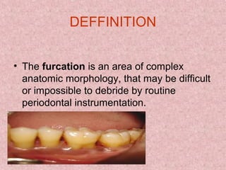 Furcation ppt | PPT