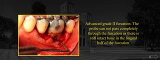 Furcations-PPT.ppt