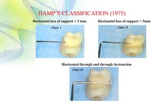 FURCATION And Its Management In Periodontics | PPTX