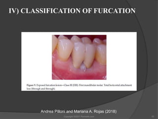 Furcation the problem and its management | PPTX
