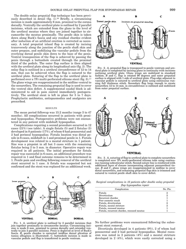 Further experience with the double onlay preputial flap | PDF