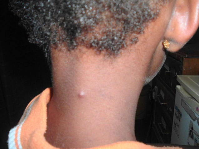 FURUNCLE.ppt | Skin and Dermatology | Diseases and Conditions