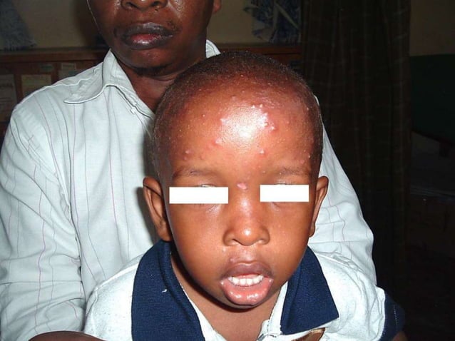 FURUNCLE.ppt | Skin and Dermatology | Diseases and Conditions