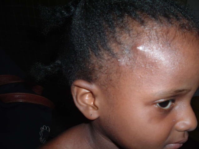 FURUNCLE.ppt | Skin and Dermatology | Diseases and Conditions