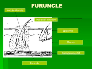 Furuncle Diagram
