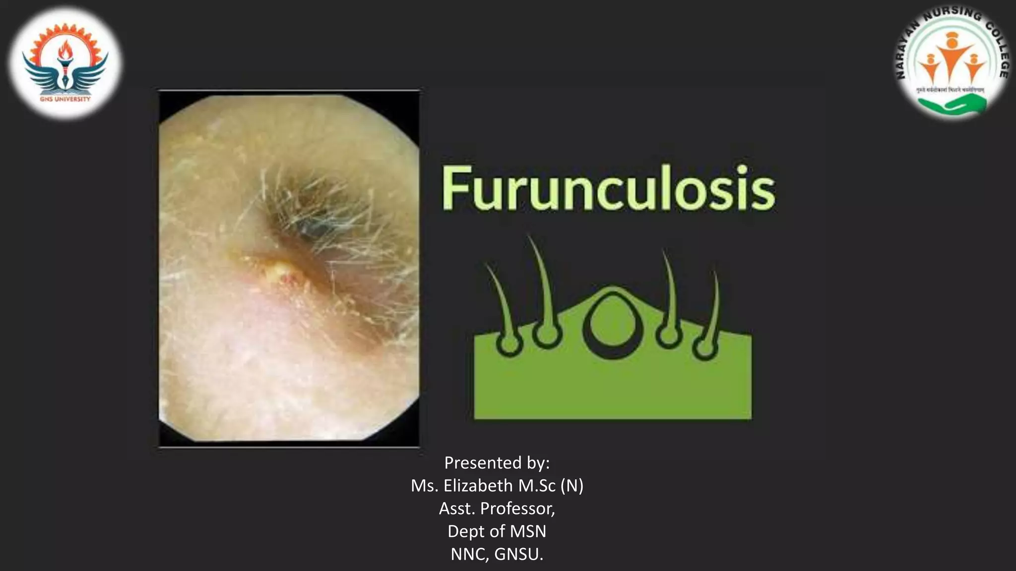 Furunculosis | PPTX