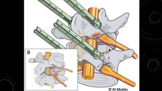 Fusion intersomatica lumbar.pptx