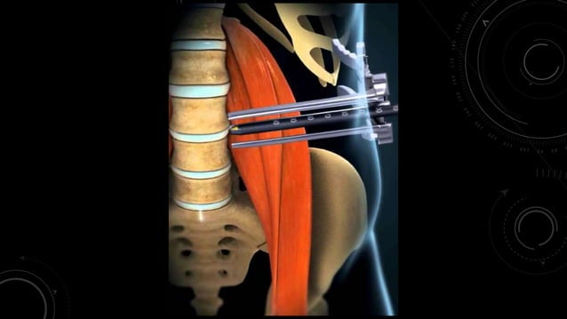Fusion intersomatica lumbar.pptx
