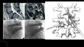Fusion intersomatica lumbar.pptx