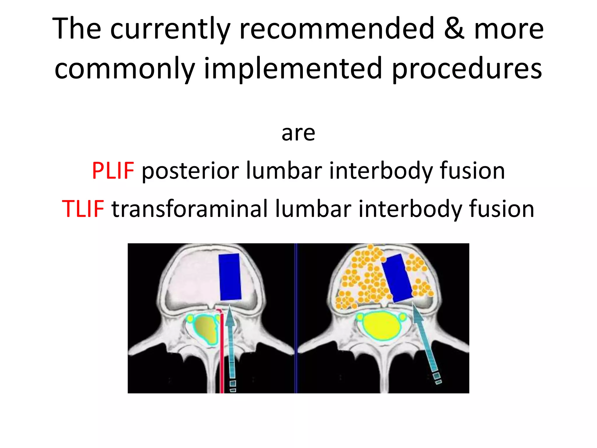 Fusion with open or minimally invasive techniques in degenerative ...