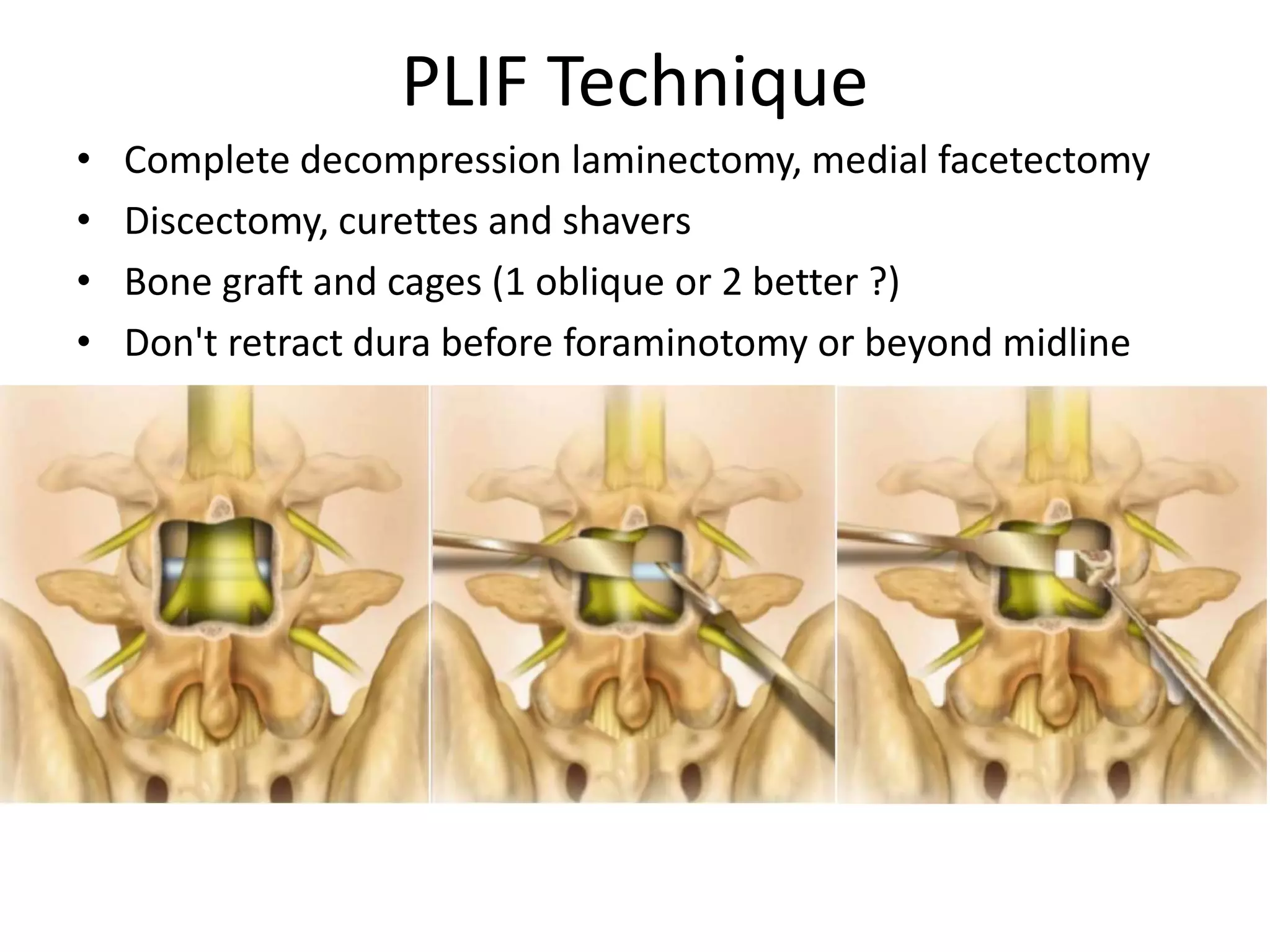 Fusion with open or minimally invasive techniques in degenerative ...
