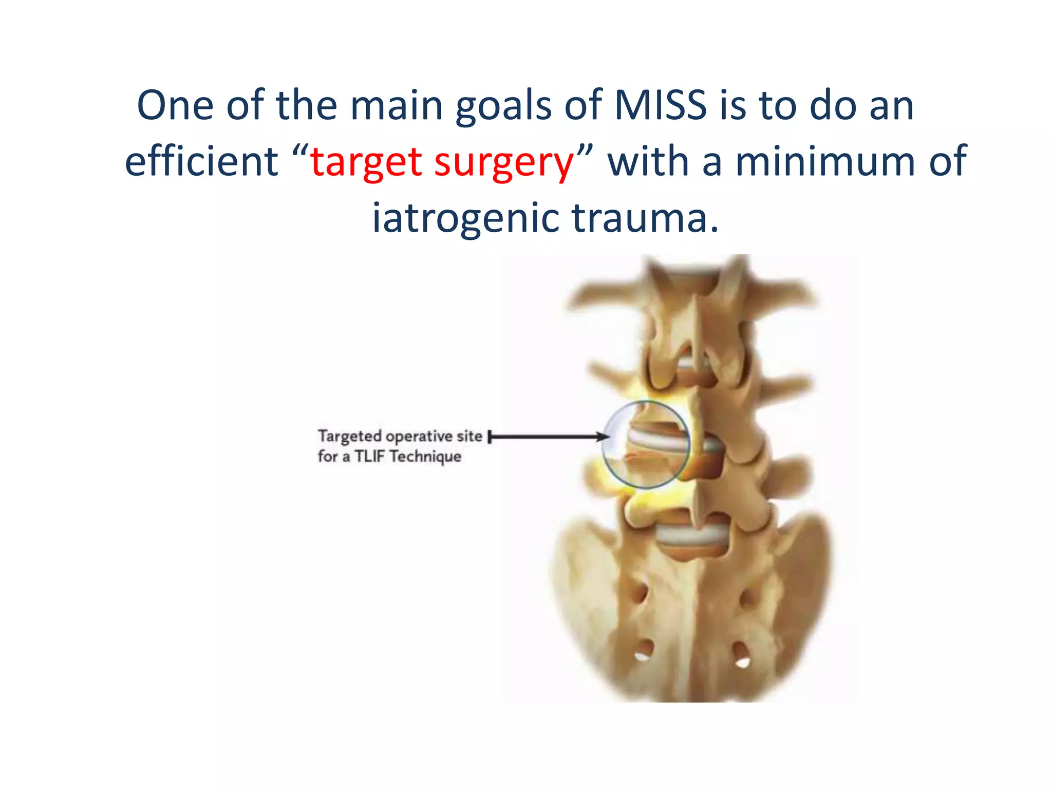 Fusion with open or minimally invasive techniques in degenerative ...
