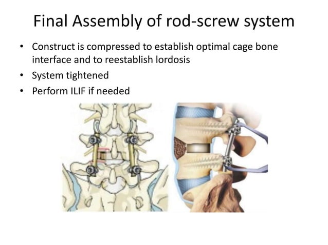 Fusion with open or minimally invasive techniques in degenerative ...