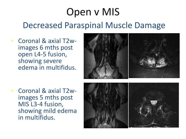 Fusion with open or minimally invasive techniques in degenerative ...