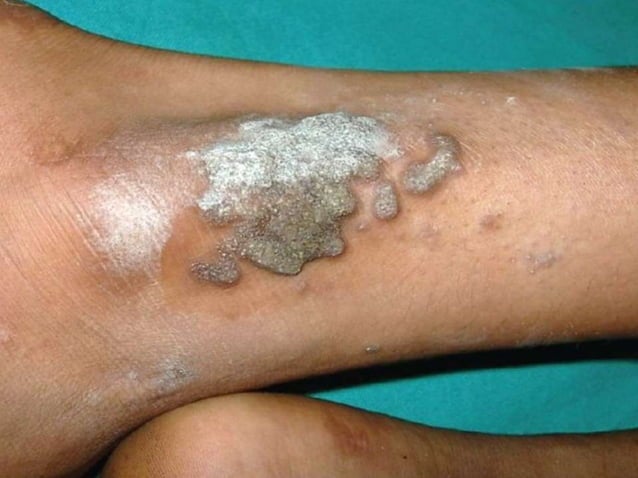 Cutaneous Tuberculosis | PPT